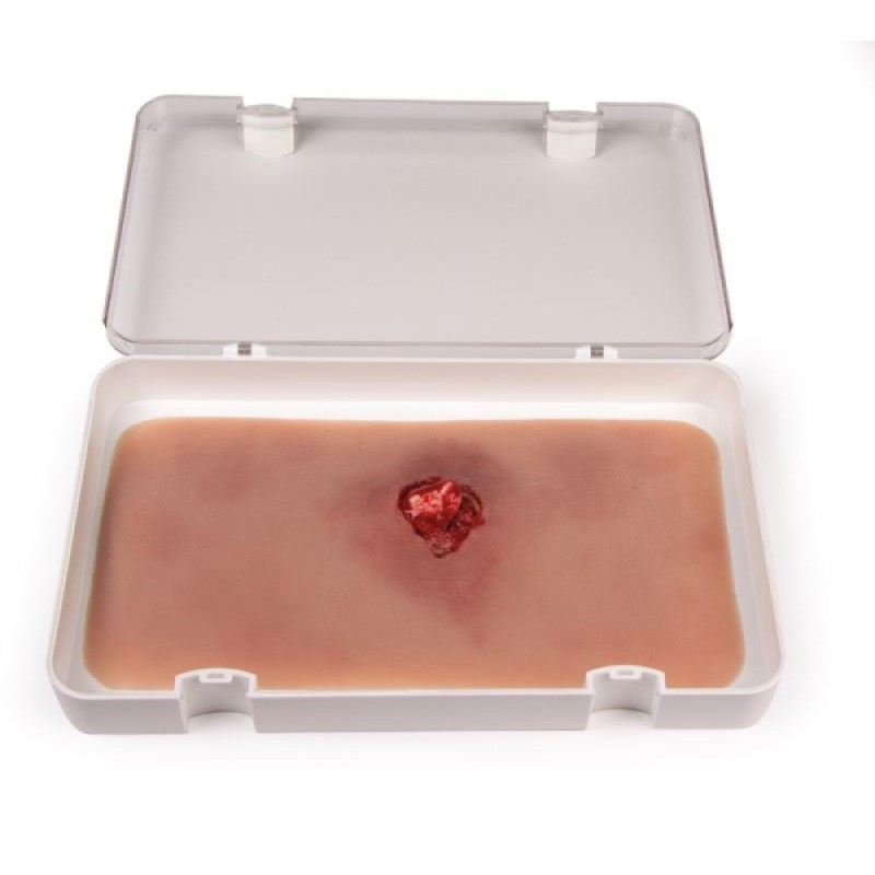 Erler Zimmer Wound Moulage Open Arm Fracture | Health and Care